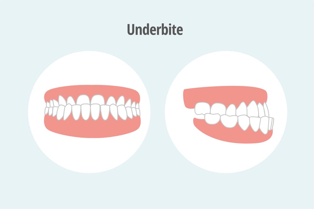 How to Fix an Underbite with At-Home Clear Aligners – Smile Perfect