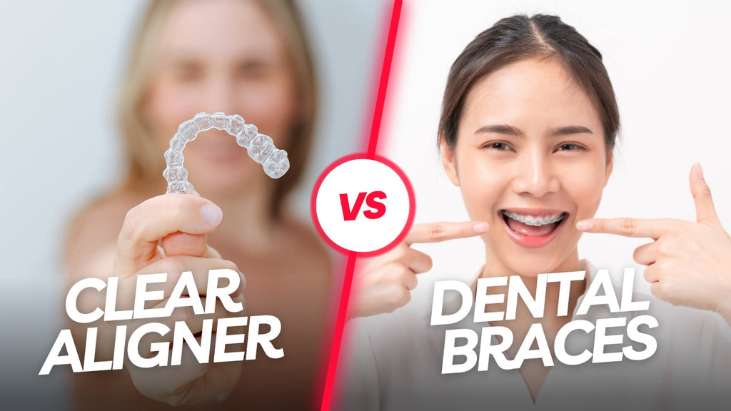 Clear Aligners vs. Braces: Pros, Cons & Key Differences Explained ...