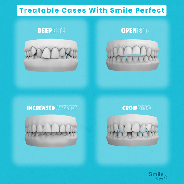 Premium Dual Arch - Clear Aligners & Invisible Braces in the USA ...